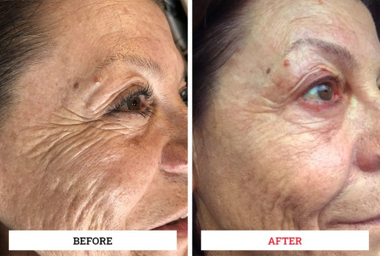 Plexr Plasma Pen – Skinstitute